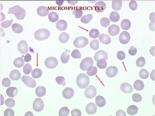 Heriditary spherocytosis | PPTX