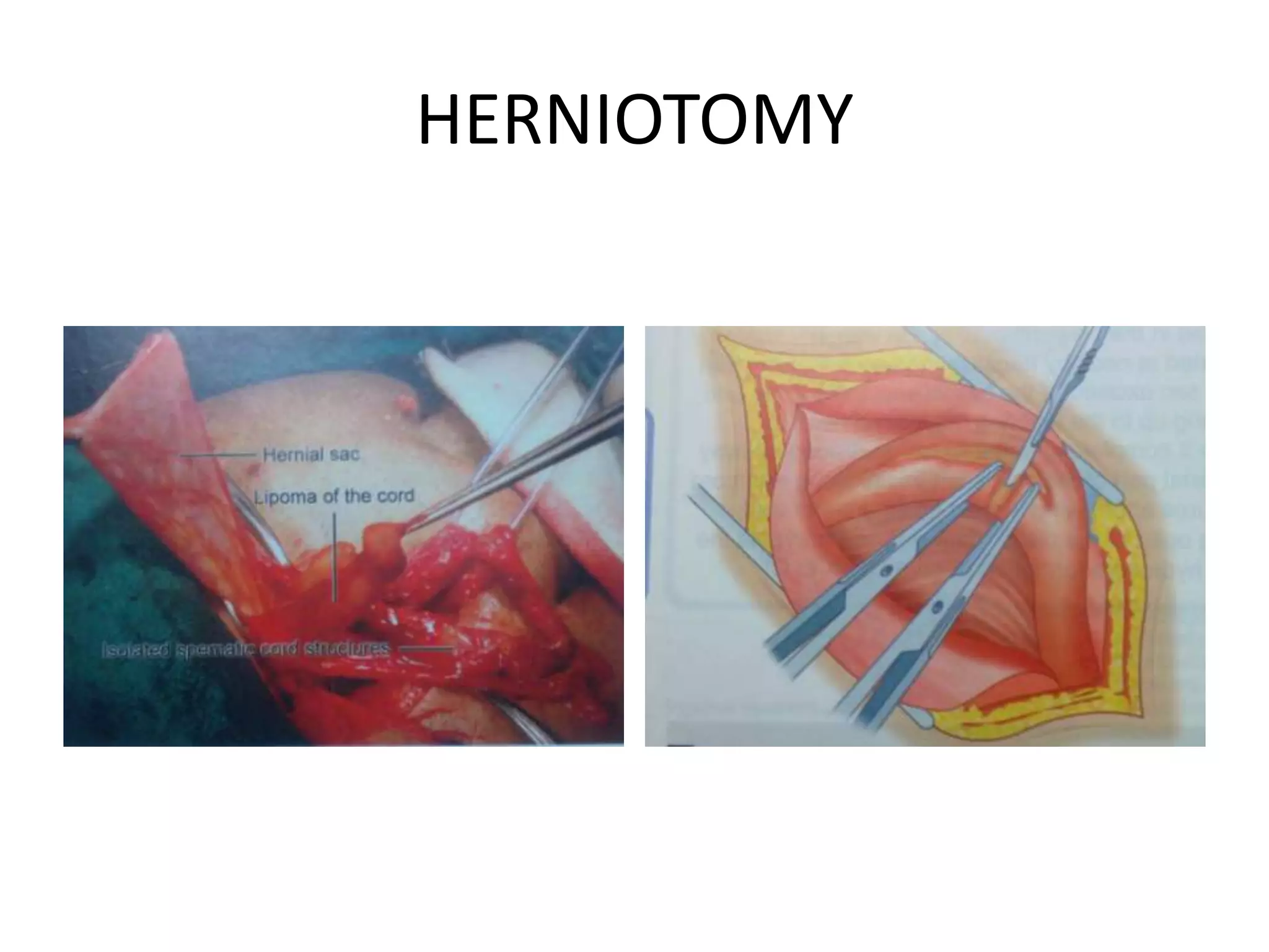 Hernia | PPTX