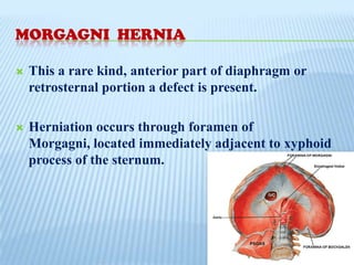 Hernia | PPTX