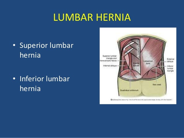 Hernia