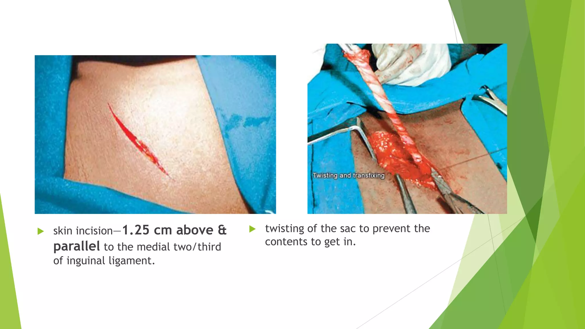 Hernia and its surgeries | PPTX