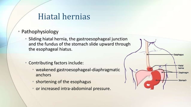 Nursing care of patients with Hernia | PPTX | Digestive Disorders | Diseases and Conditions