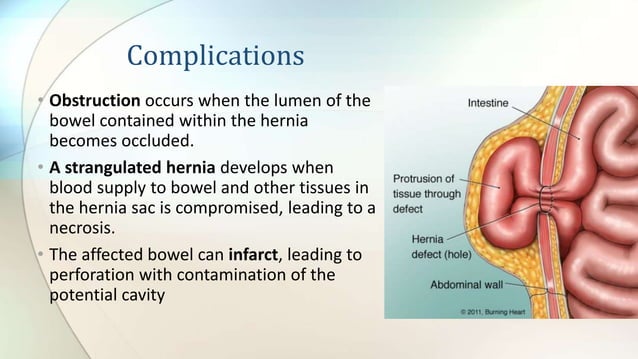 Nursing care of patients with Hernia | PPTX | Digestive Disorders | Diseases and Conditions