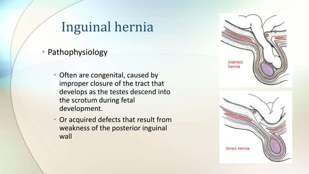 Nursing care of patients with Hernia | PPTX | Digestive Disorders | Diseases and Conditions