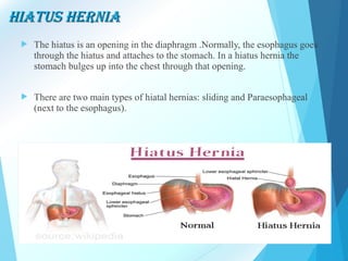 Hernia | PPT