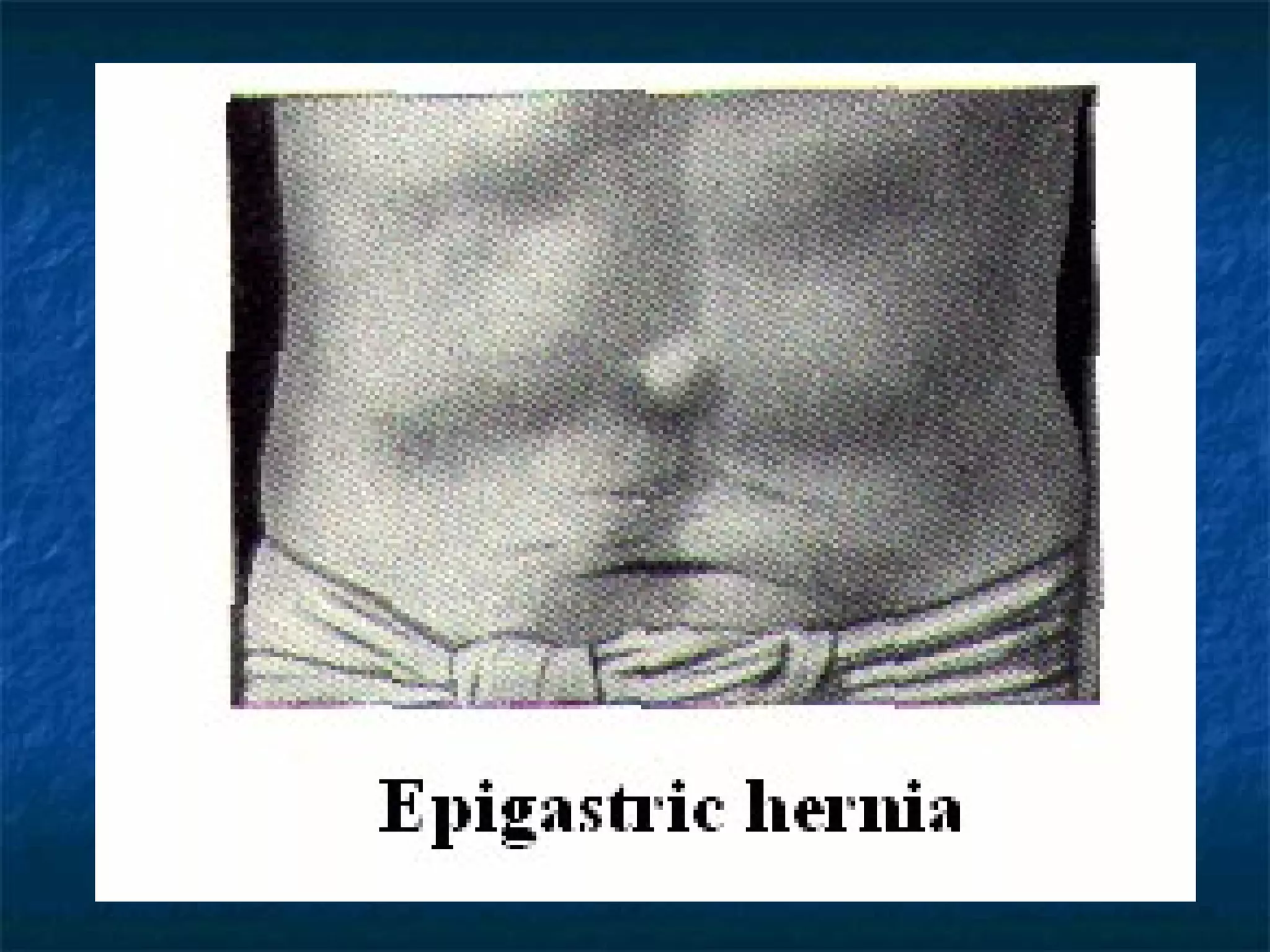 Hernia | PPT