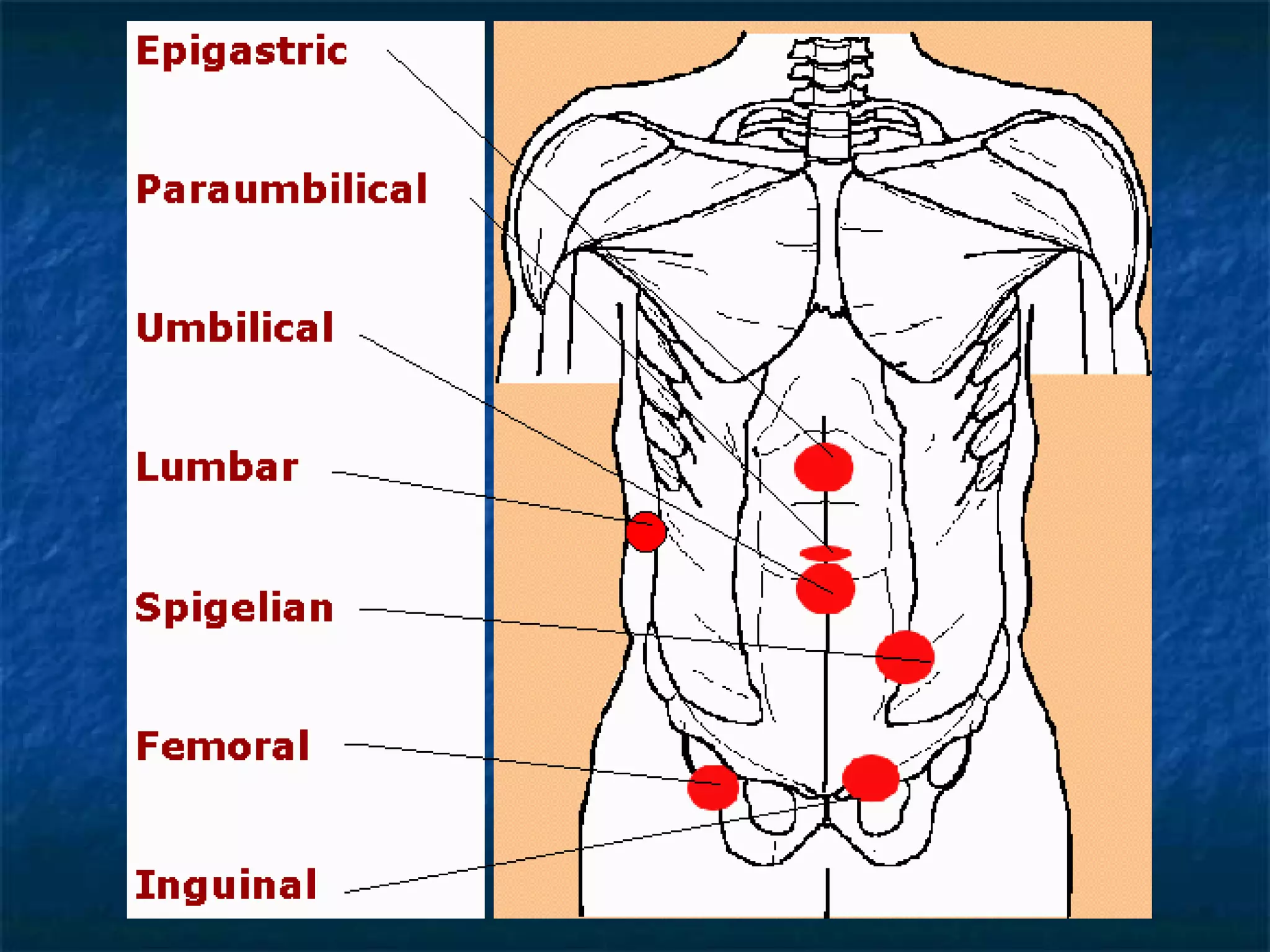 Hernia | PPT