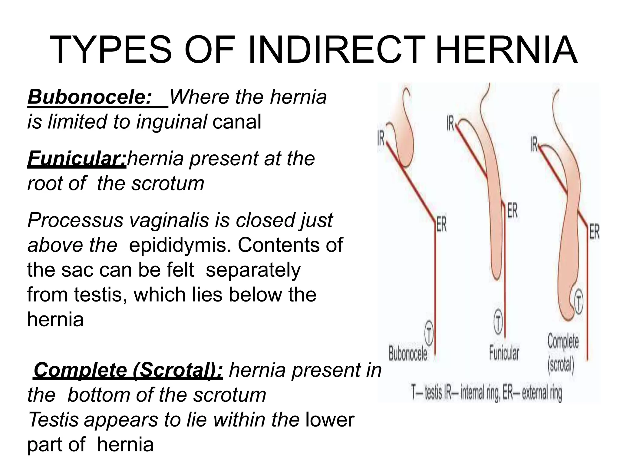 Hernia | PPTX