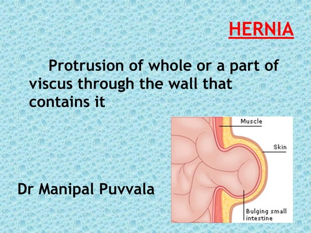 Hernia | PPT