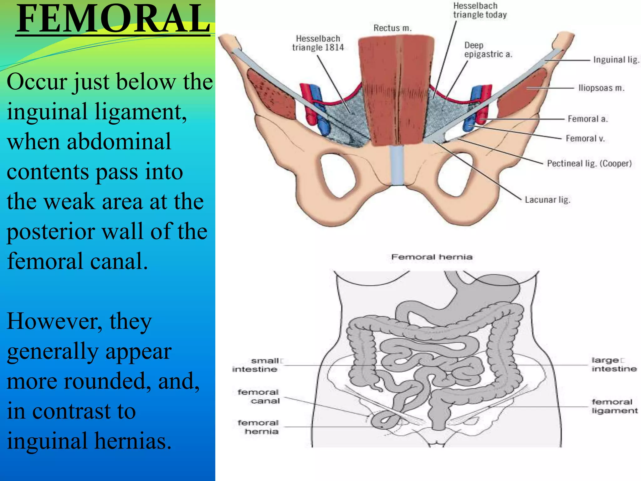 Hernia | PPT