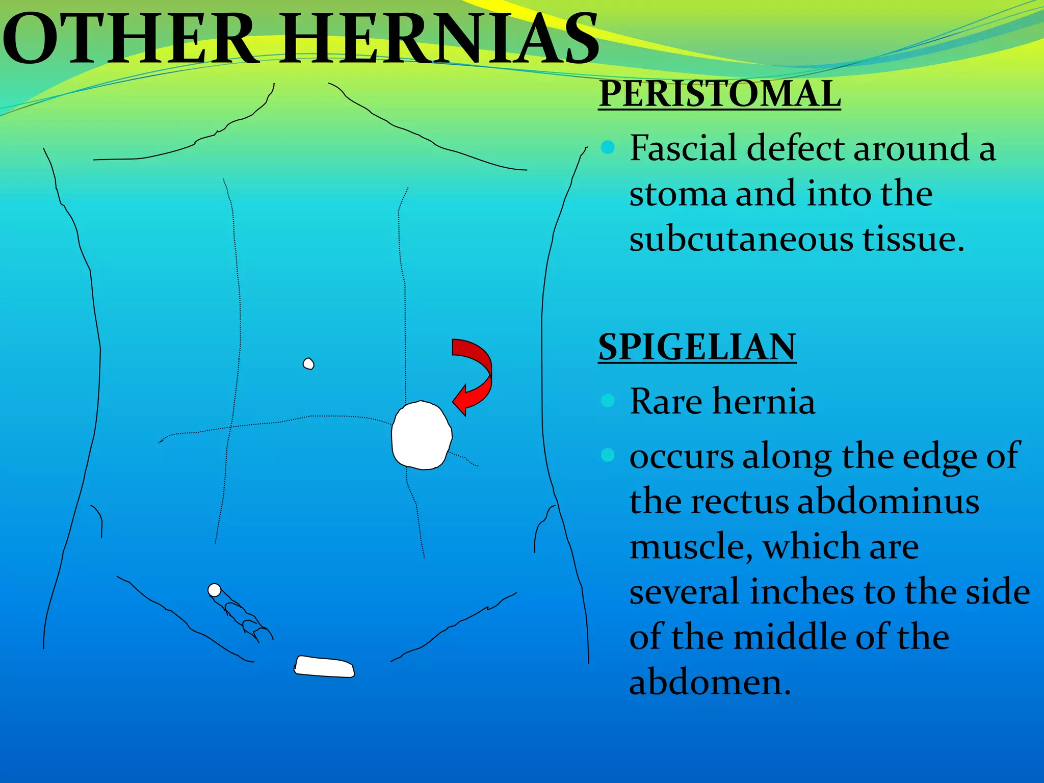 Hernia | PPT