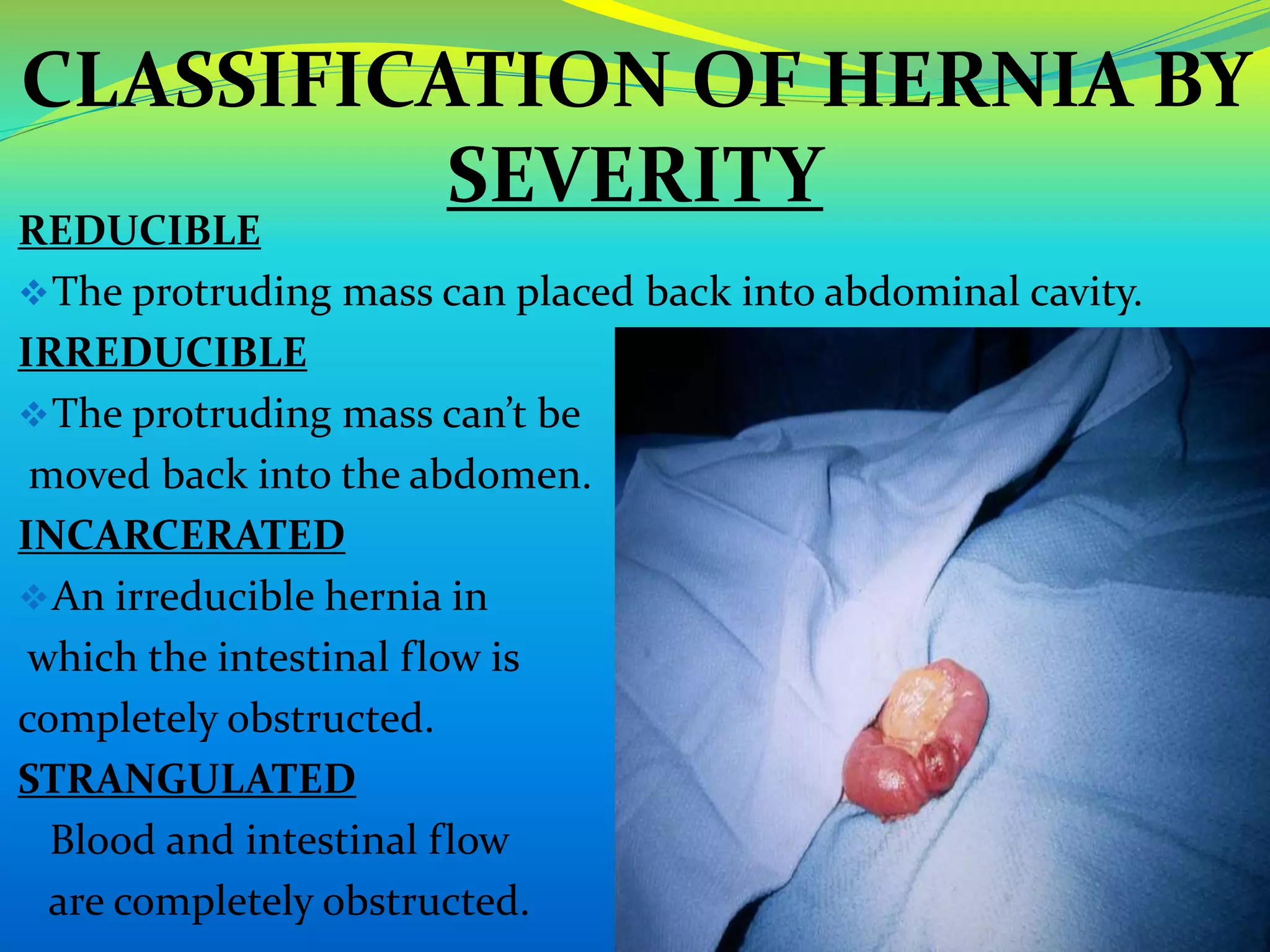 Hernia | PPT