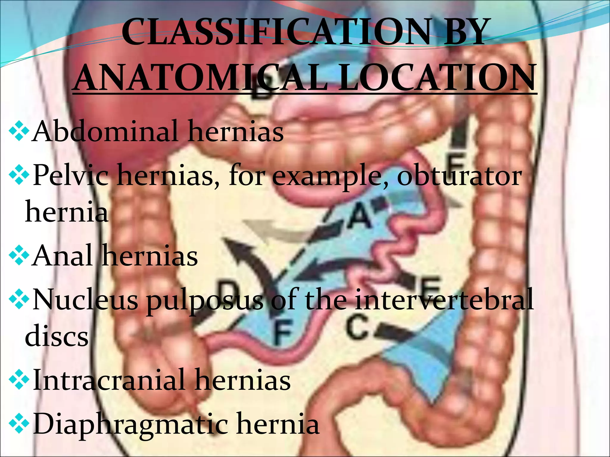 Hernia | PPT