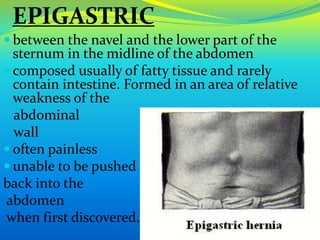 Hernia | PPT