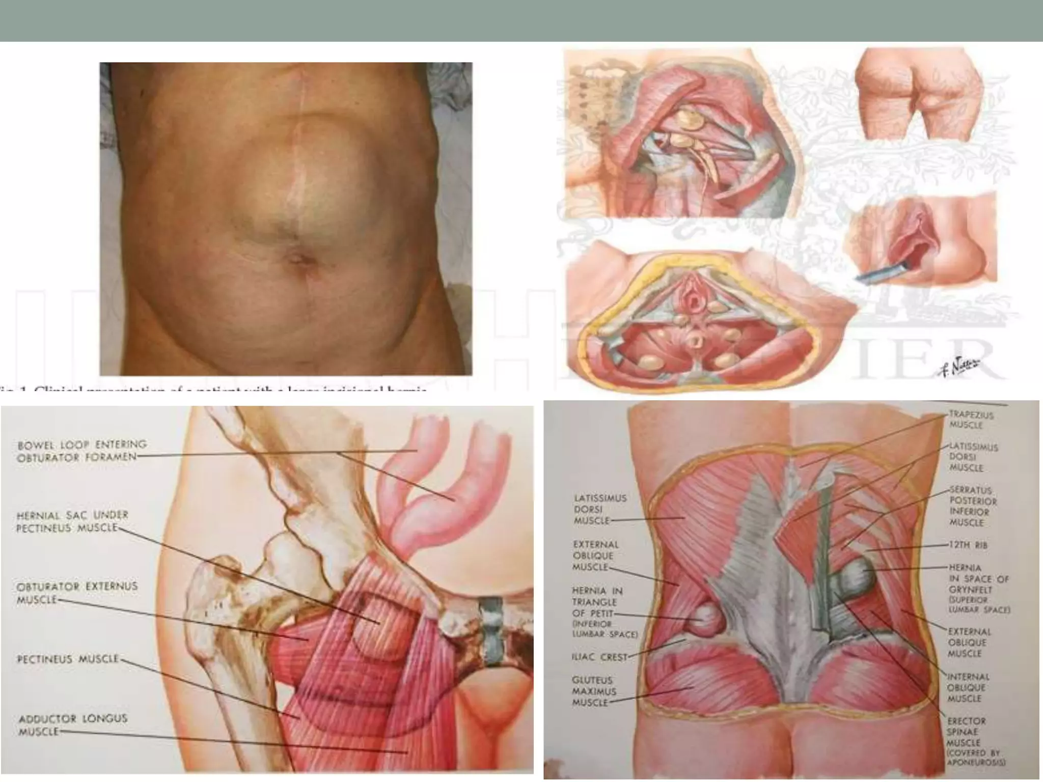 Hernias | PPTX
