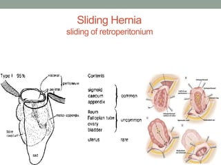 Sliding Inguinal Hernia