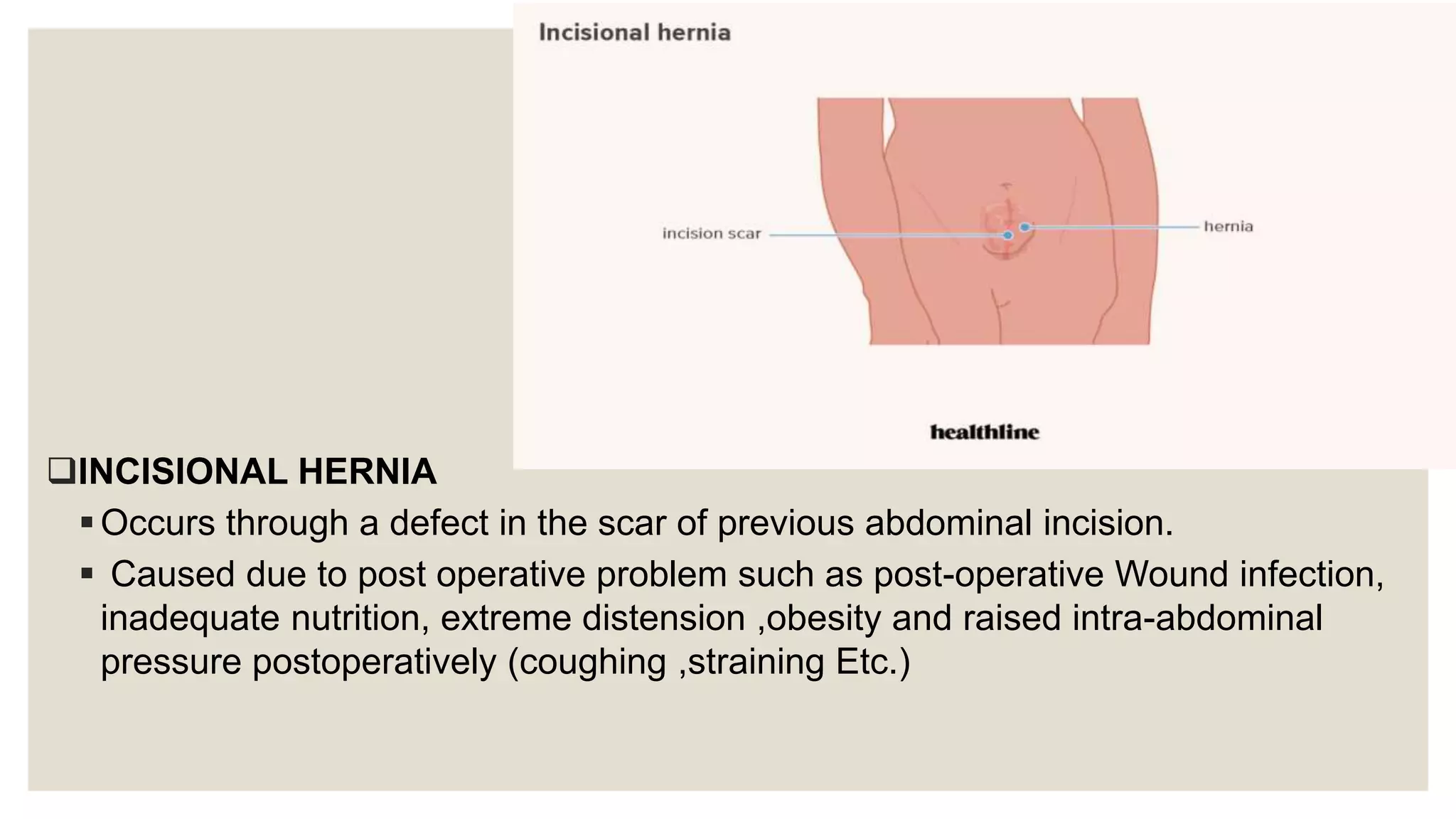 Hernia | PPTX