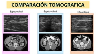 HERNIA.pptx