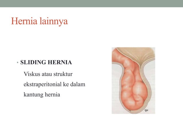 HERNIA.pptx