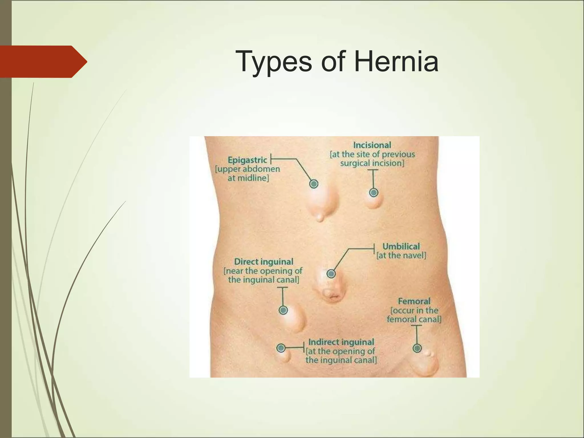 Hernia.ppt