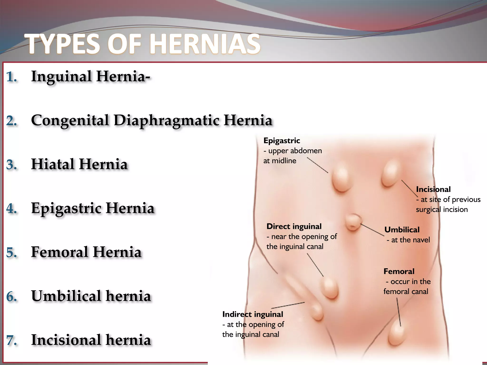 Hernia.pdf