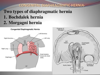 Hernia.pdf | Death, Injury, or Military Conflict | Sensitive Topics
