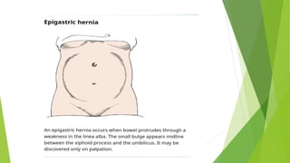 Hernia.pptx
