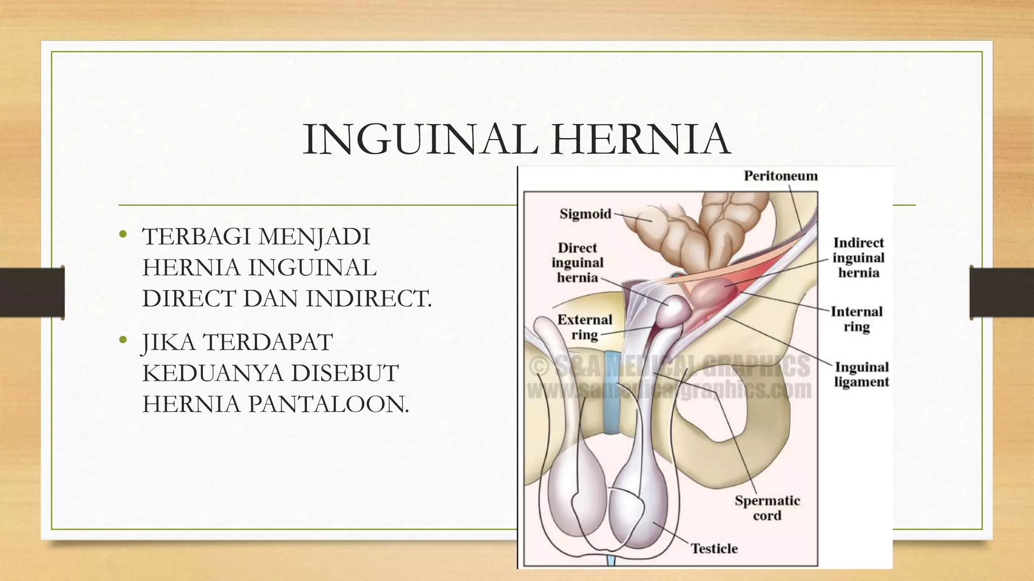 hernia.pptx