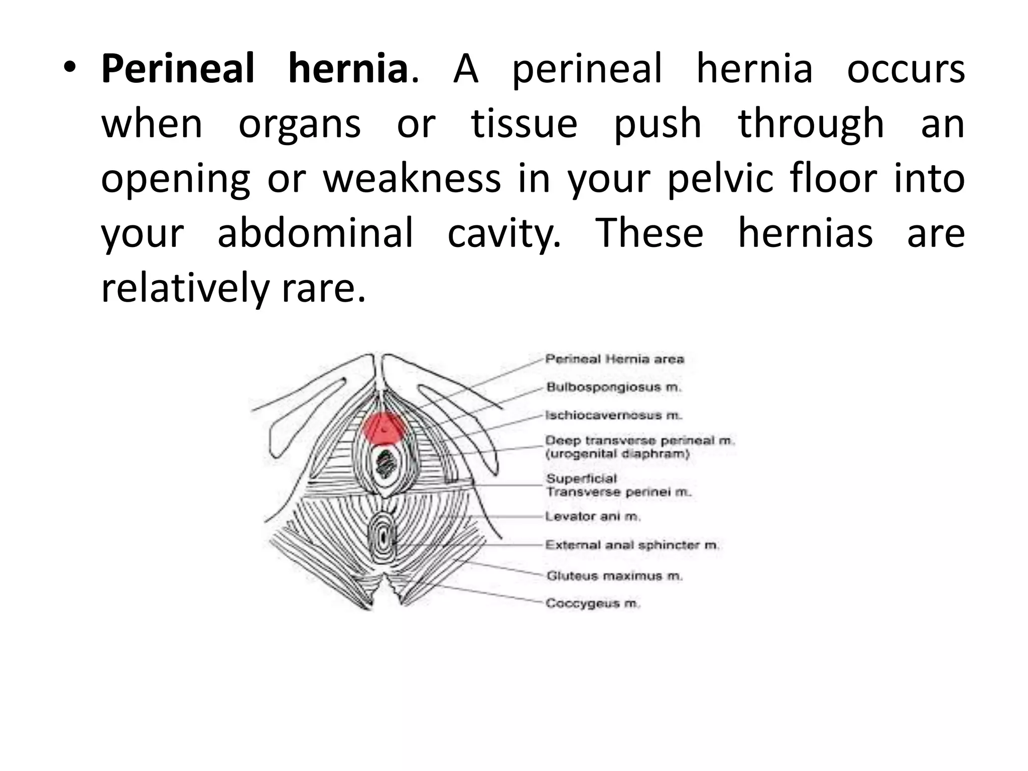 hernia.pptx
