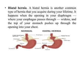 hernia.pptx