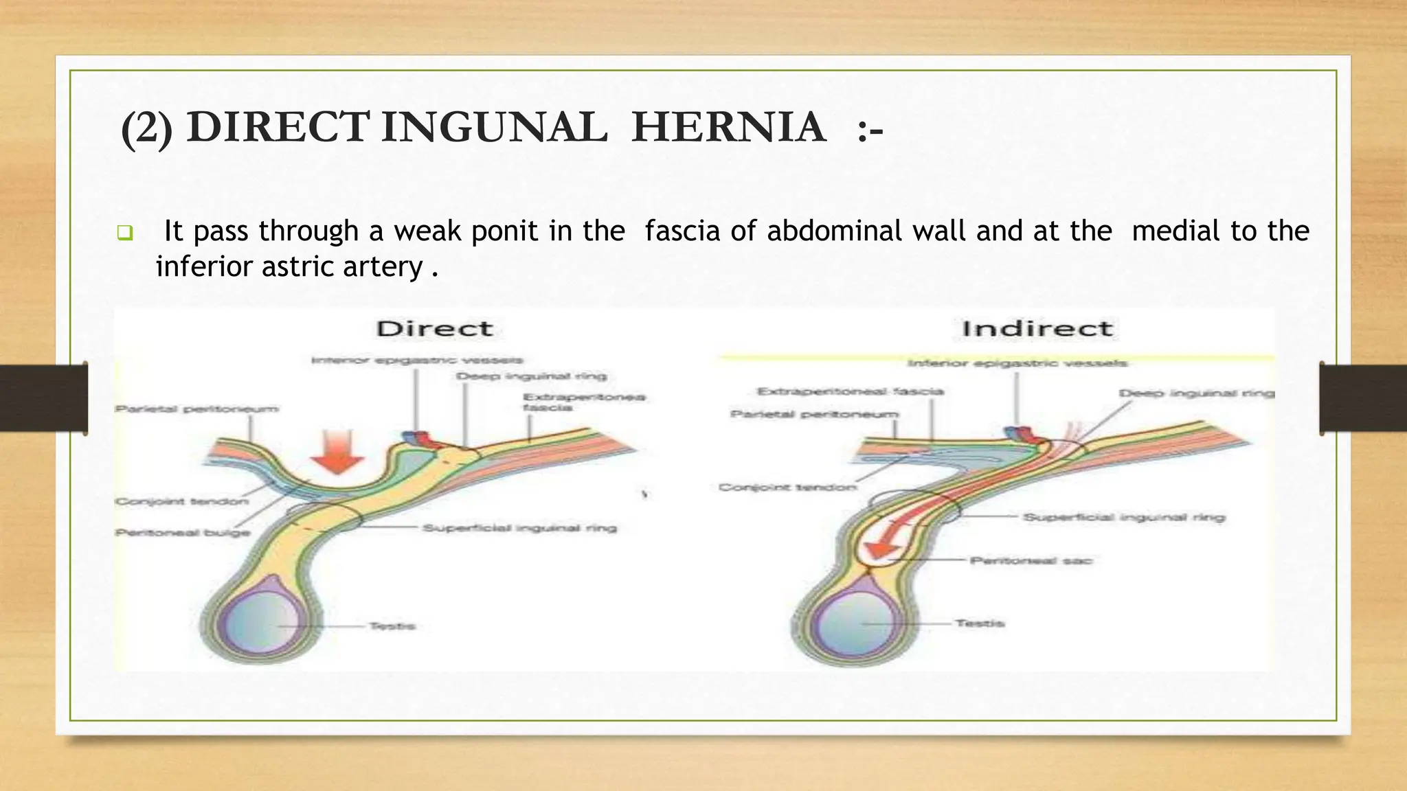hernia and its treatment and nursing management .pptx