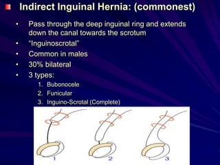 Surgical anatomy and treatments for Hernia.pdf