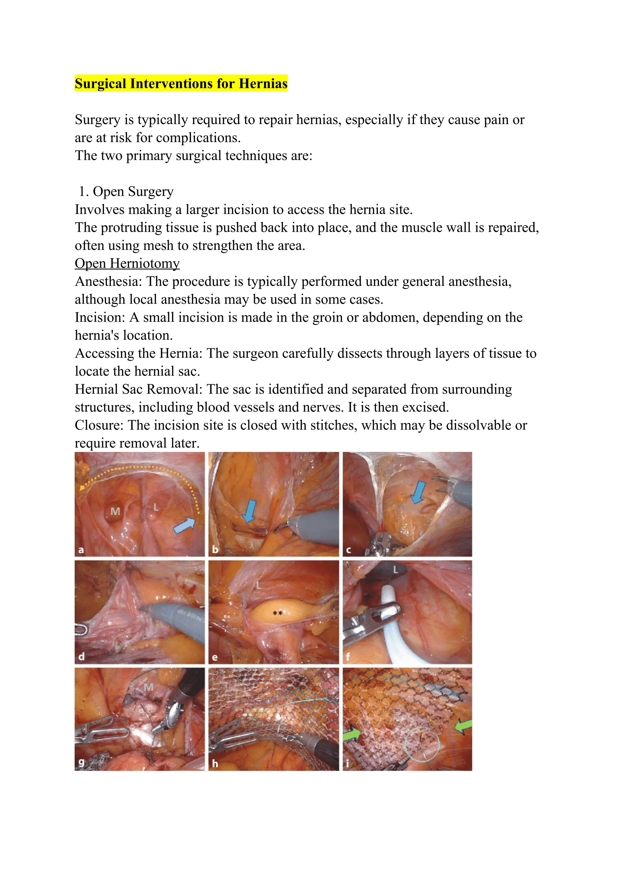 Hernia - Defination, Types, complications , precautions, surgery ...