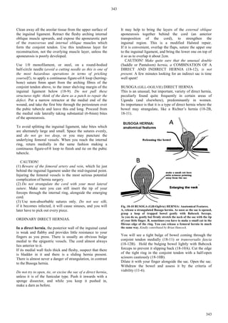 hernia inguinal different type and its techniques to repair | PDF