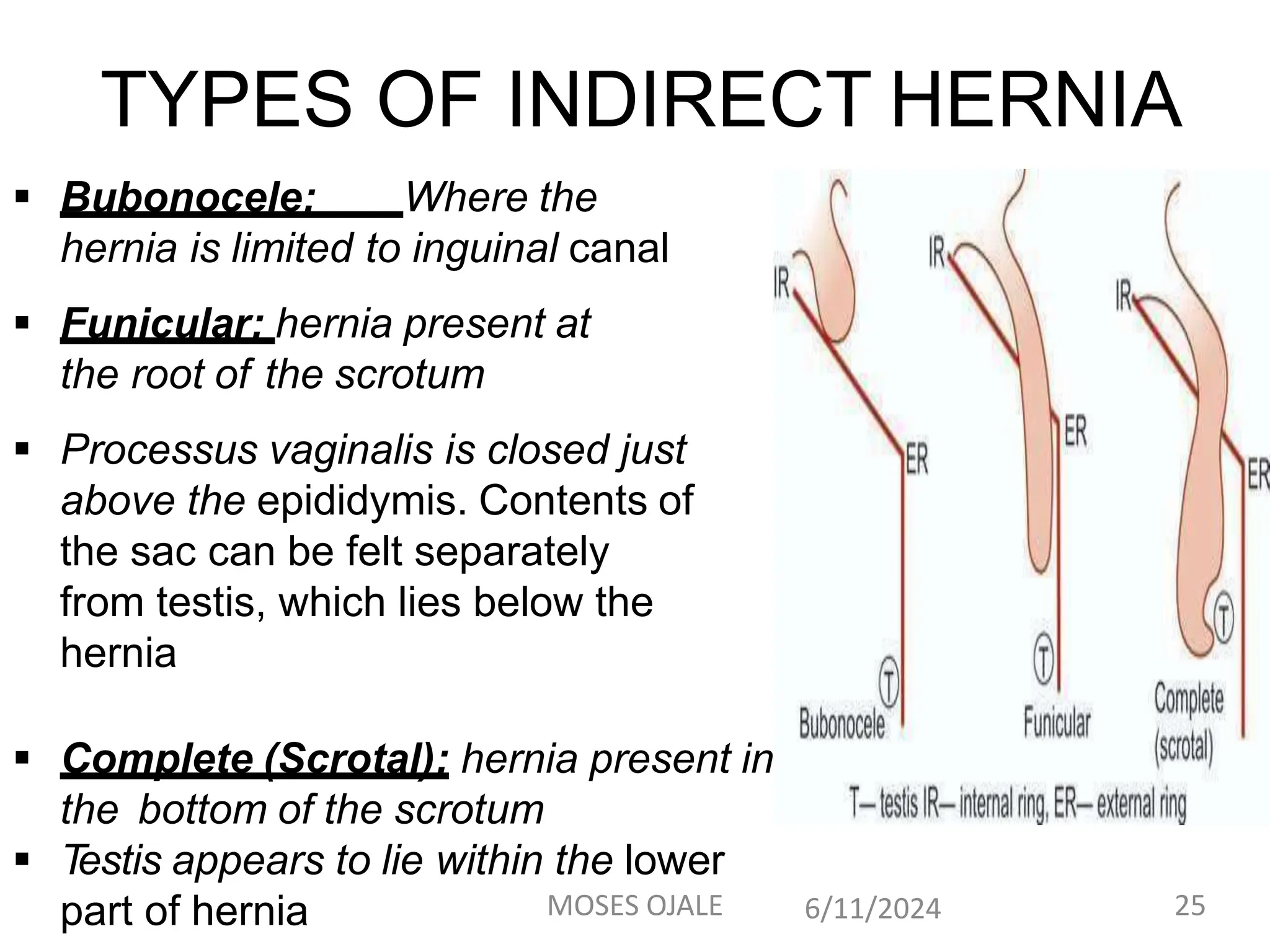 hernia- good notes for DCM COMPLETE.pptx