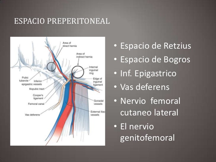 Hernia inguinal