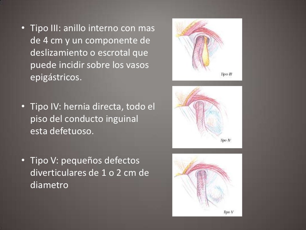 Hérnia Inguino Escrotal Cid - RETOEDU