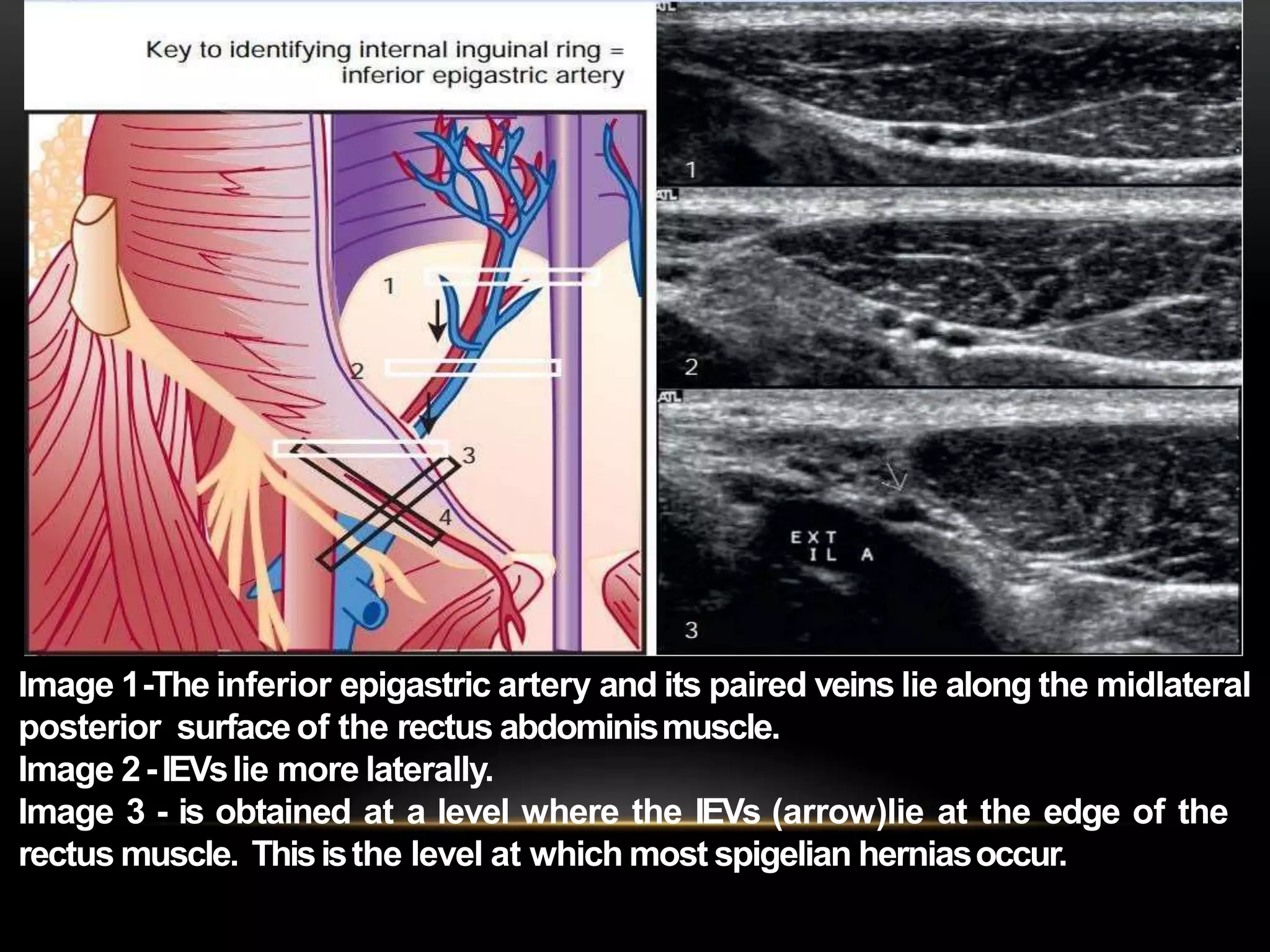 Ultrasound of Hernia | PPTX