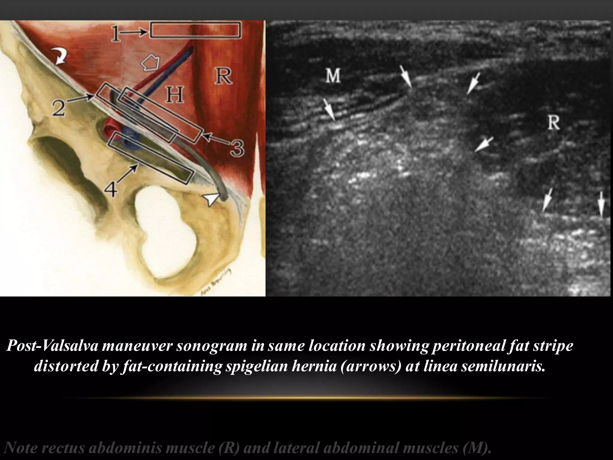 Ultrasound of Hernia | PPTX