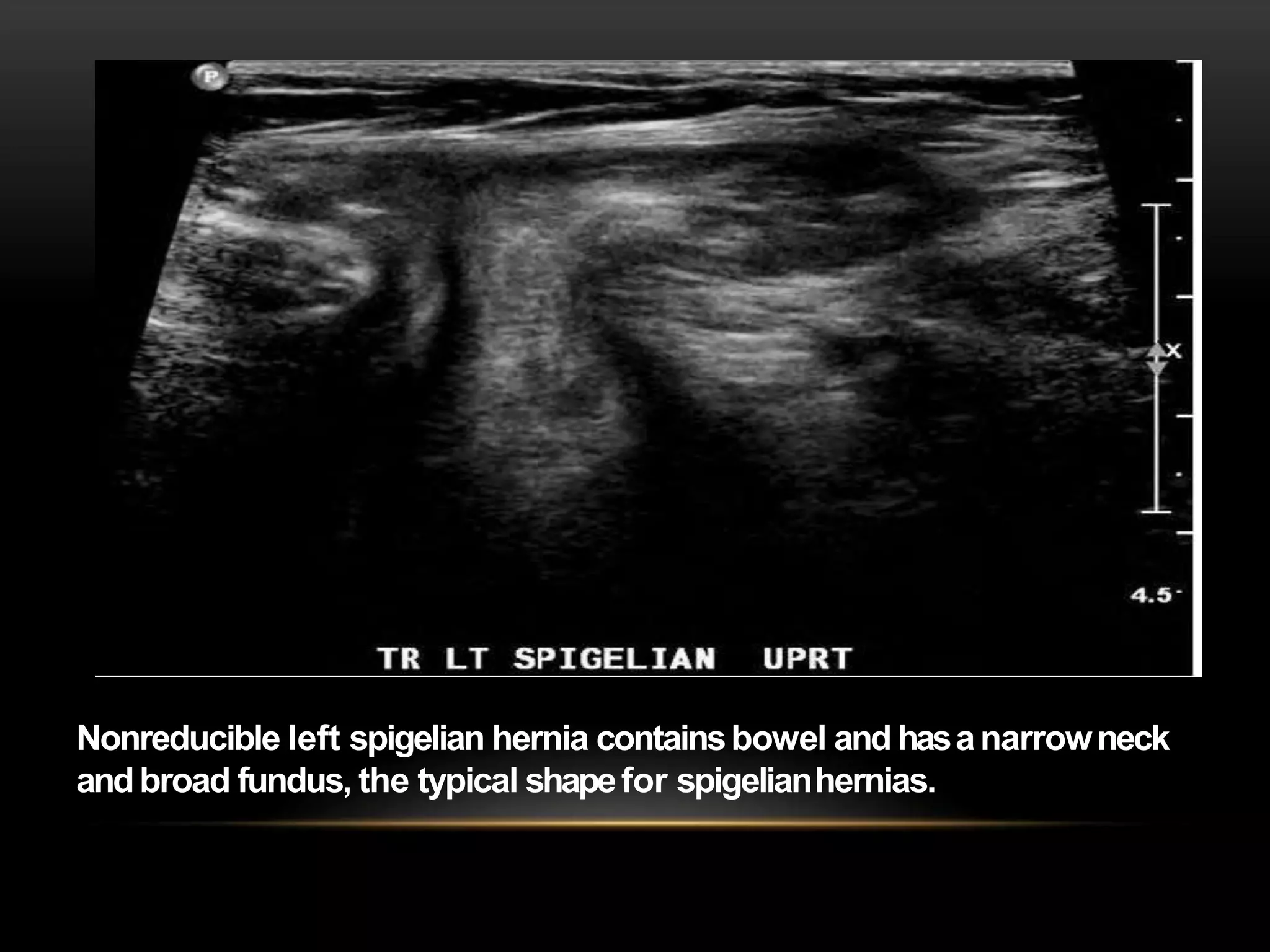 Ultrasound of Hernia | PPTX