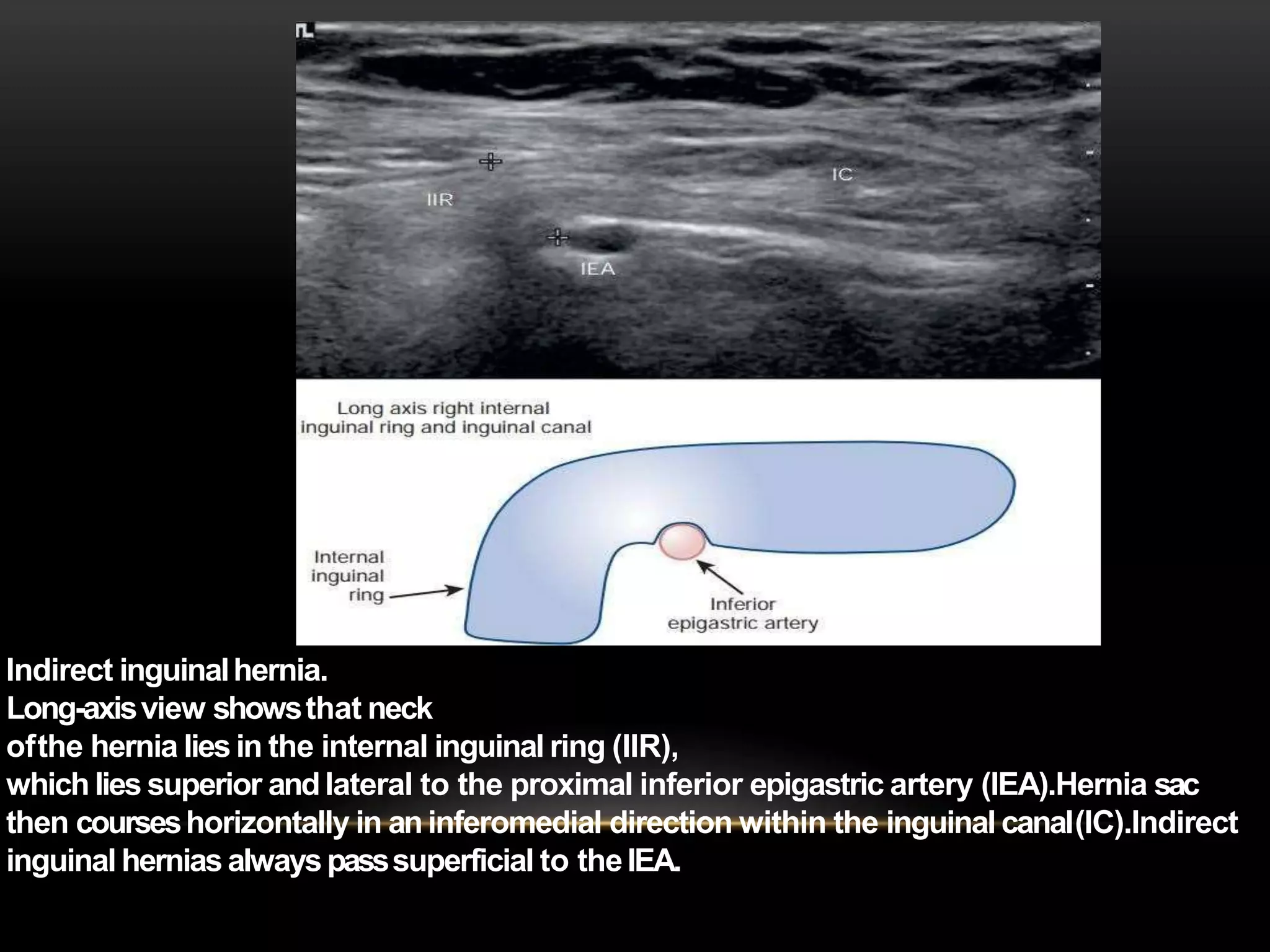 Ultrasound of Hernia | PPTX
