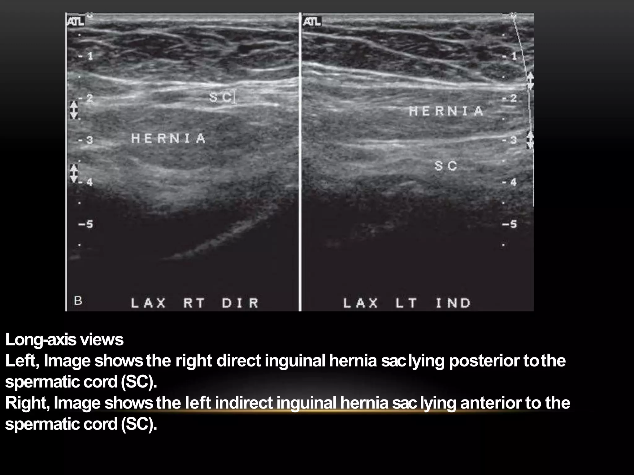 Ultrasound of Hernia | PPTX