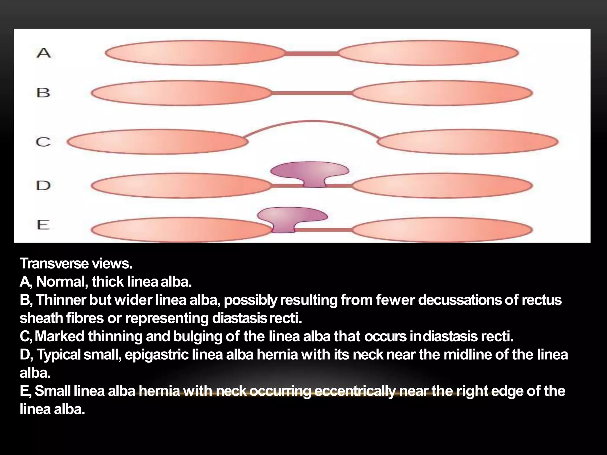 Ultrasound of Hernia | PPTX