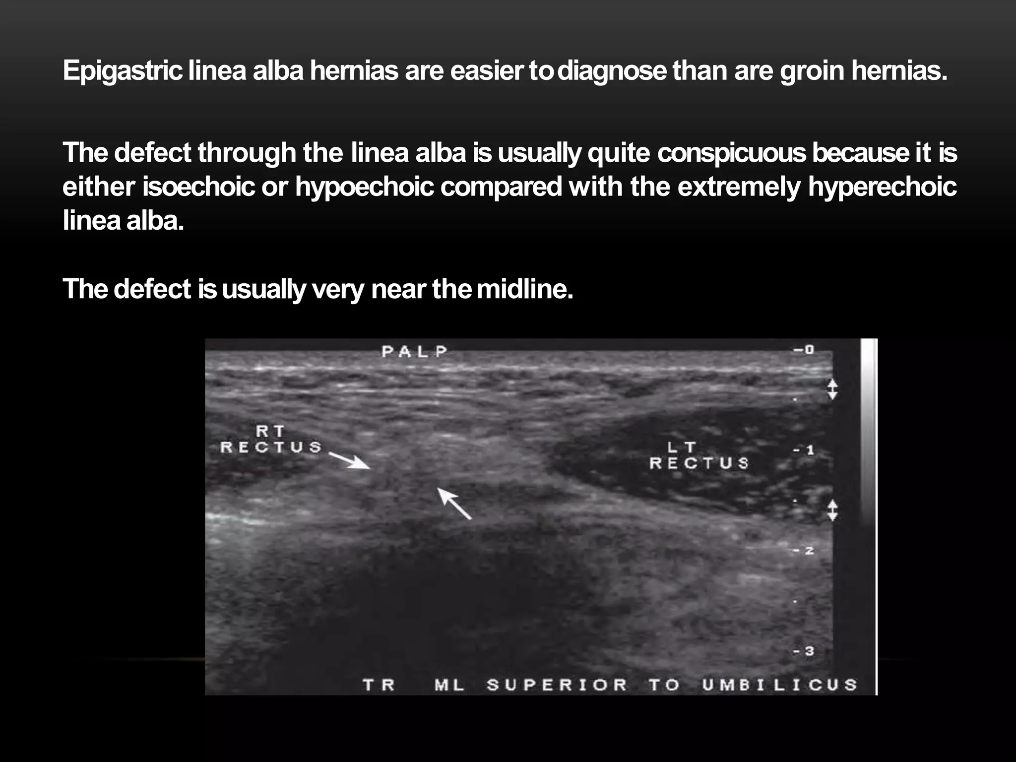 Ultrasound of Hernia | PPTX