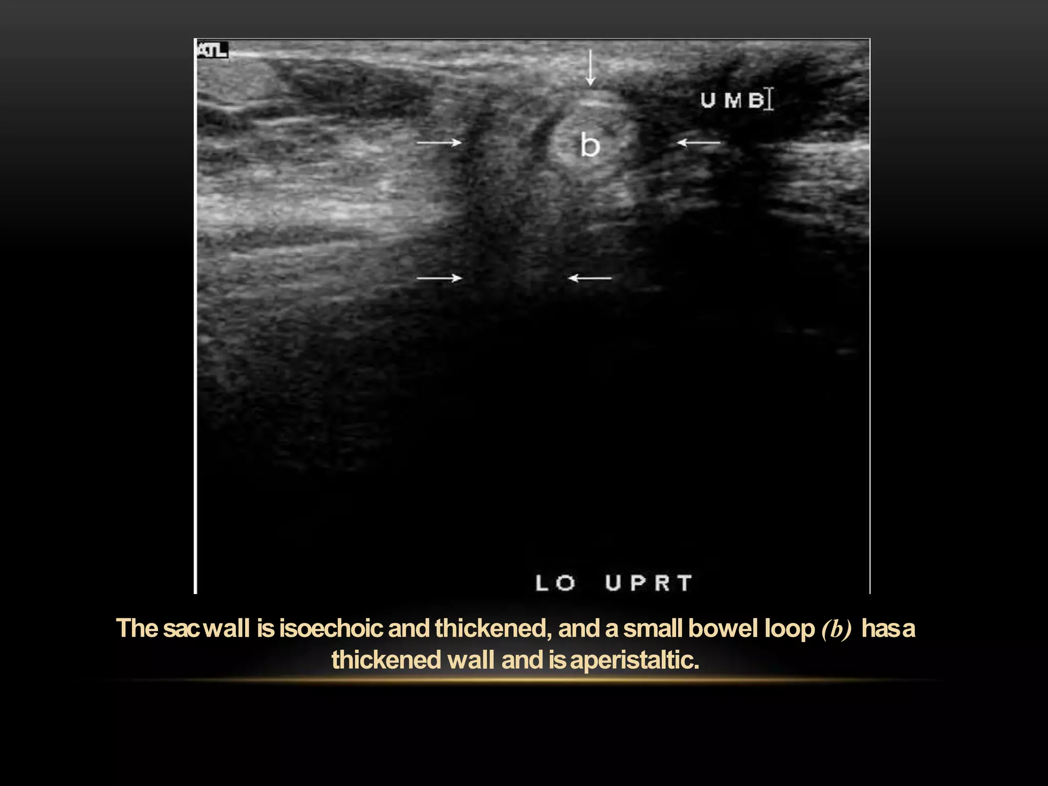 Ultrasound of Hernia | PPTX