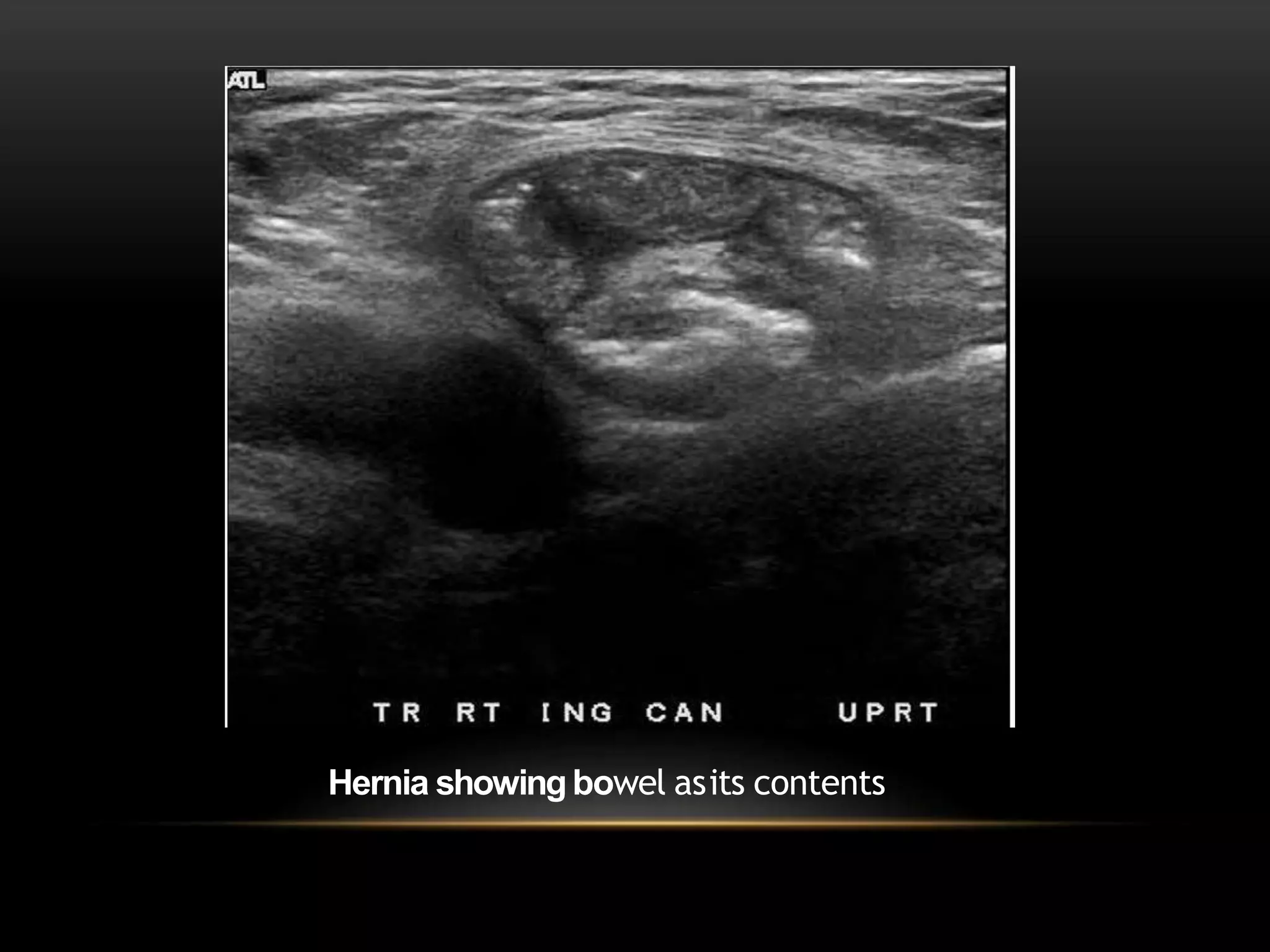 Ultrasound of Hernia | PPTX