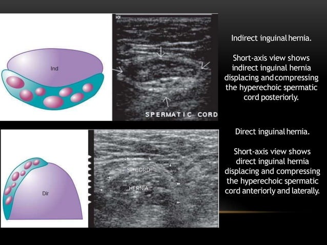 Ultrasound of Hernia | PPTX