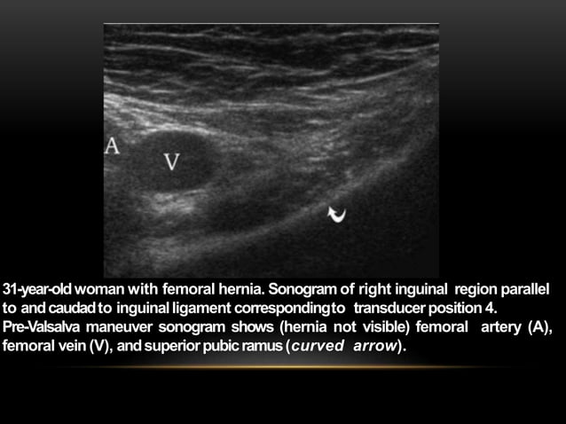 Ultrasound of Hernia | PPTX