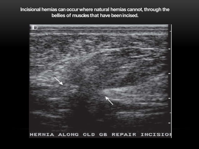 Ultrasound of Hernia | PPTX