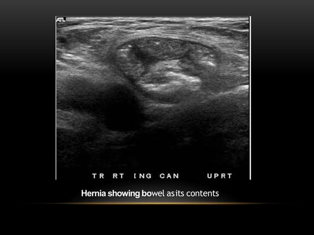 Ultrasound of Hernia | PPT